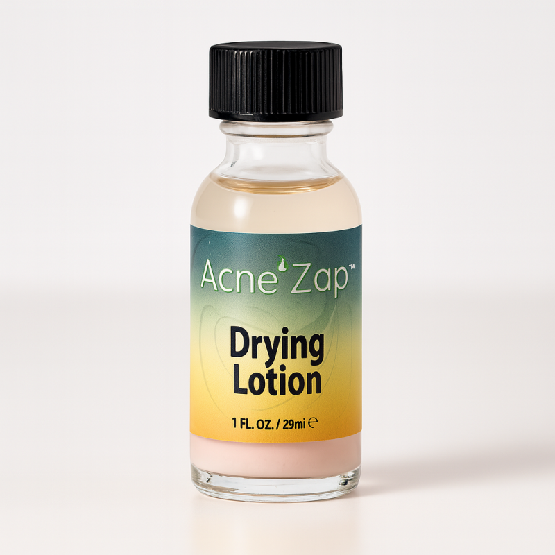 Ovante AcneZap Drying Lotion With Sulfur Salicylic Acid Spot Treatment